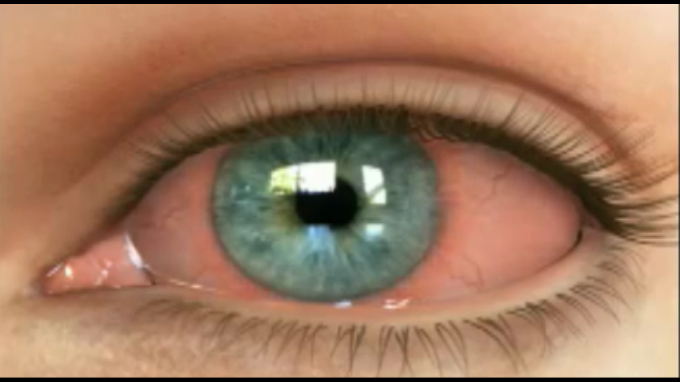 Mucho ojo con la conjuntivitis, evite el contagio | Videos | Agencia ...